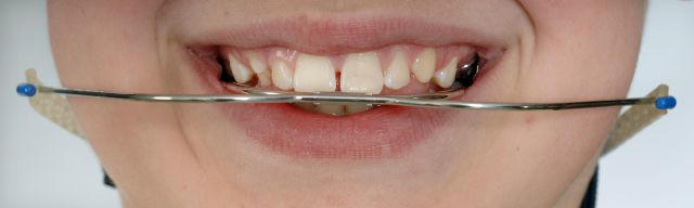 Gewone beugels - Beugels - Behandeling - Orthodontiepraktijk Harderwijk ...