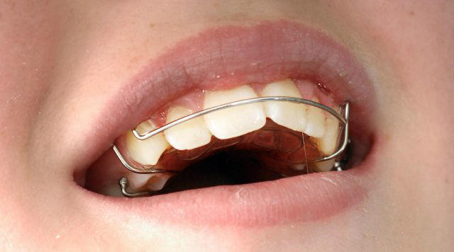 Gewone beugels - Beugels - Behandeling - Orthodontiepraktijk Harderwijk ...