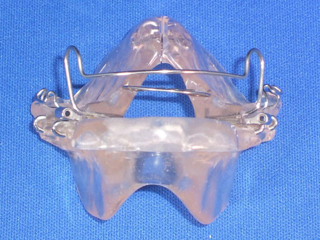 Gewone beugels - Beugels - Behandeling - Orthodontiepraktijk Harderwijk ...