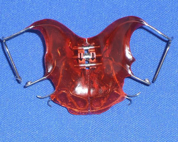 Gewone beugels - Beugels - Behandeling - Orthodontiepraktijk Harderwijk ...