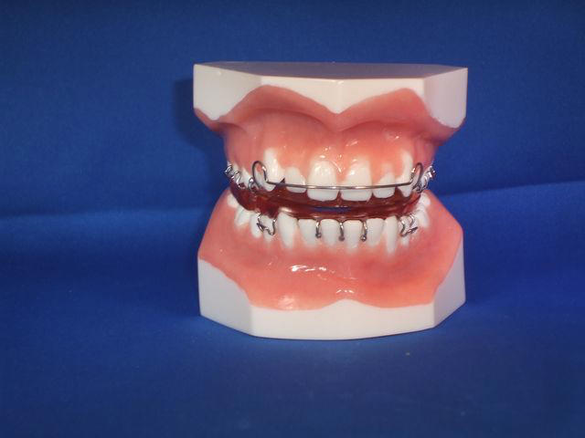 Gewone beugels - Beugels - Behandeling - Orthodontiepraktijk Harderwijk ...